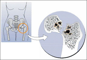 Build Healthier Hips to Reduce Your Fracture Risk - Arthritis Advisor
