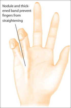 Dupuytrens Disease: The Curious Condition That Causes Finger ...