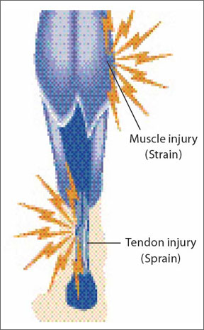 Sprain vs. Strain: Different Injuries, Same Treatment - Arthritis Advisor