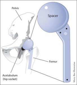 Antibiotic Spacers Can Help Heal Infected Hip Replacements - Arthritis ...