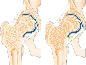 Six Steps To Keeping Hips Healthy - Arthritis Advisor