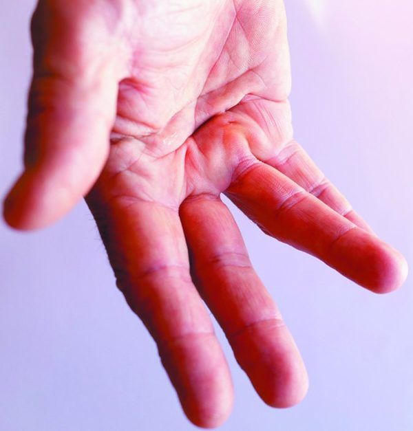 When Fingers Curl and Wont Unfurl - Arthritis Advisor