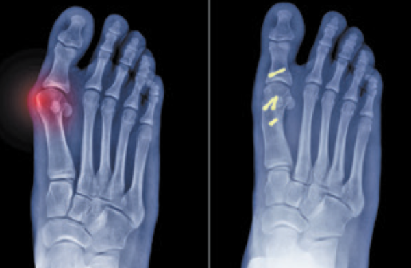 Surgery for Bunions - Arthritis Advisor