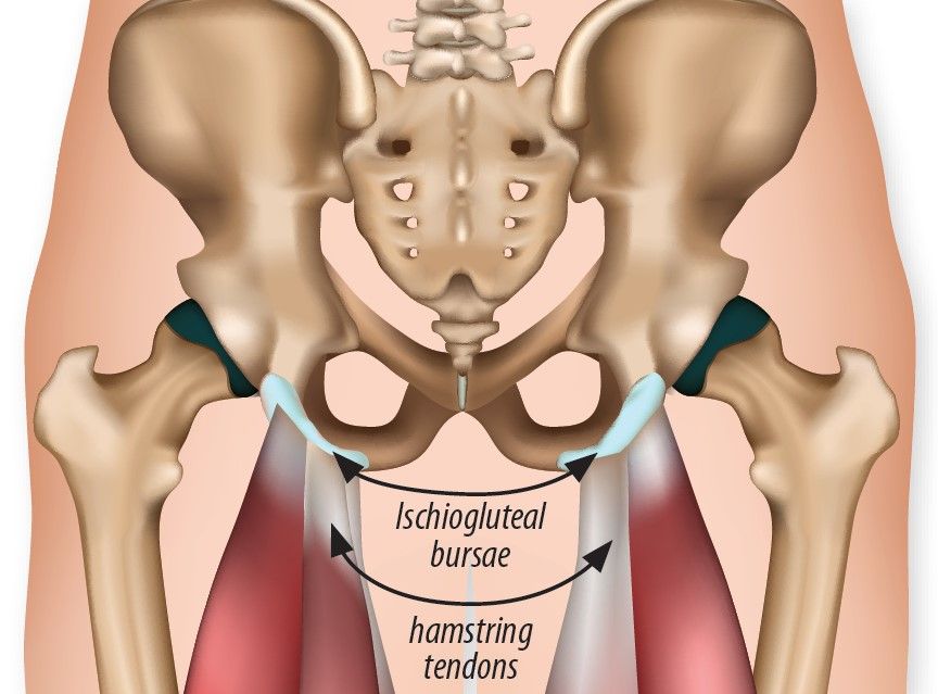 Ischial Bursitis Ischial Bursitis