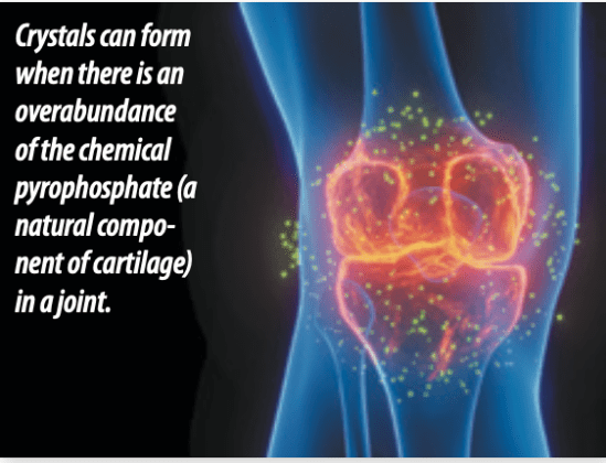 Understanding CPPD - Arthritis Advisor