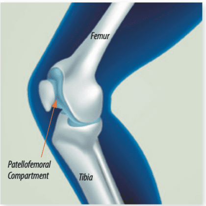 Patellofemoral Replacement - Arthritis Advisor