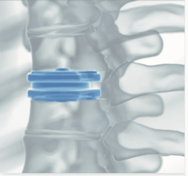 Spinal Disk Replacement - Arthritis Advisor